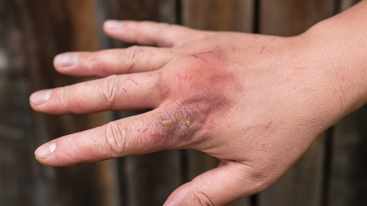 Ketahui Pertolongan Pertama pada Luka Bakar - TIKTAK.ID